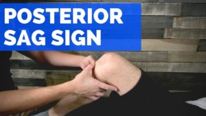 Posterior Sag Sign | PCL Tear Test • PTProgress